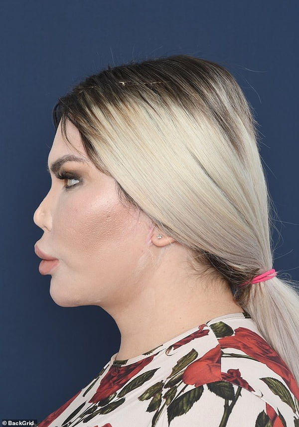 Ex-Ken Humano mostra resultado de feminização facial: “Menininha ...