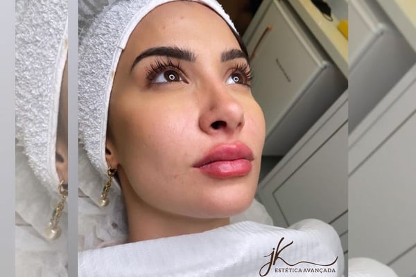 Veja como ficou o rosto de Boca Rosa após harmonização facial | Metrópoles