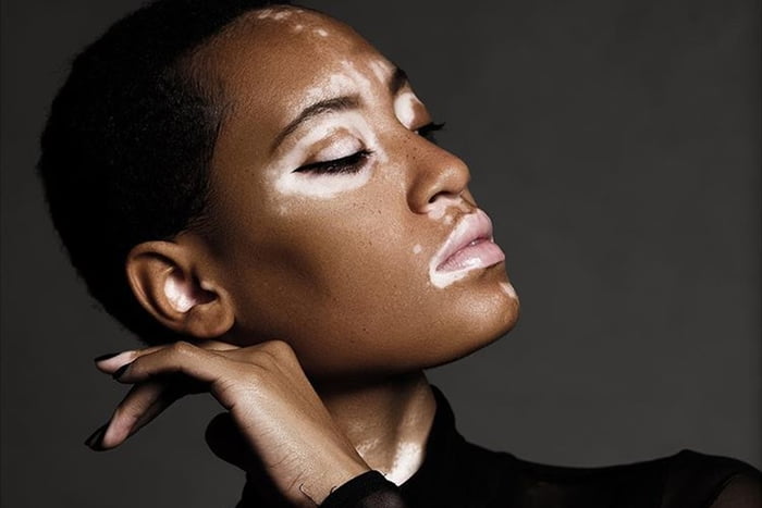 Modelo com vitiligo brilha em nova campanha da CoverGirl | Metrópoles
